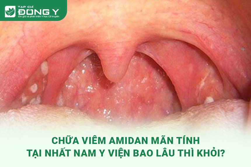 Cách Chữa Viêm Amidan Mãn Tính: Phương Pháp Hiệu Quả Và An Toàn