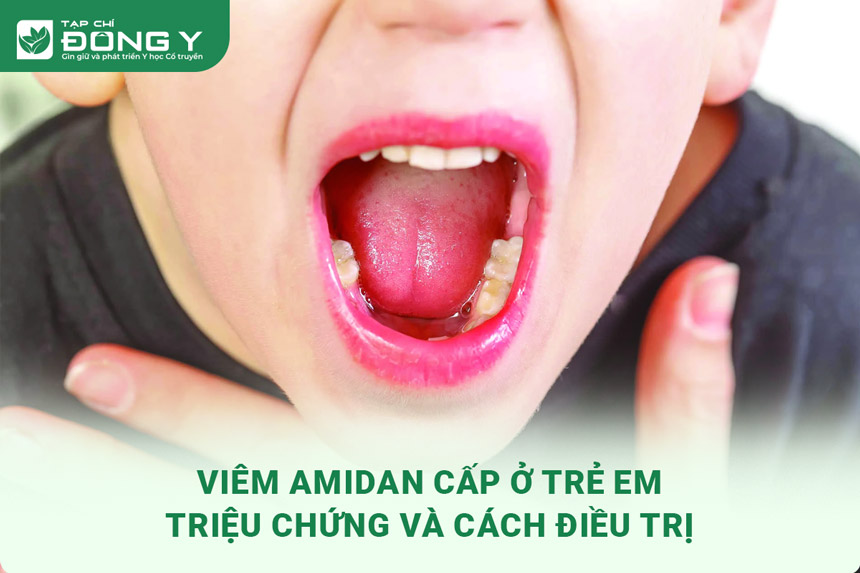 Nguyên nhân, triệu chứng và điều trị viêm amidan cấp ở trẻ